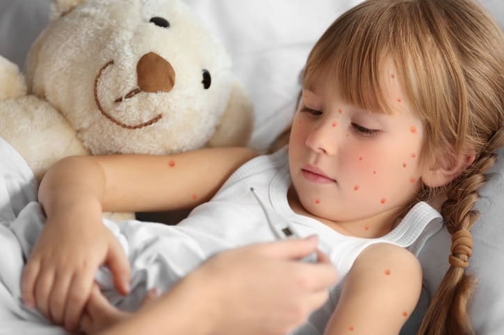 Chickenpox: Causes, Symptoms, Treatment & Prevention - FOKP